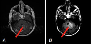 Posterior Fossa Metastasis - DocNeuro