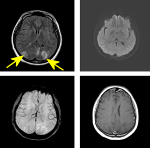 PRES – Posterior Reversible Encephalopathy Syndrome - DocNeuro