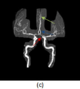 Anterior Cerebral Artery Territory Infarct - DocNeuro
