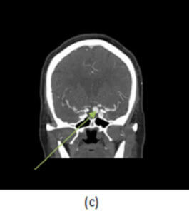 Fusiform Aneurysm - DocNeuro