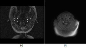 Carotid Artery Dissection, MRA - DocNeuro
