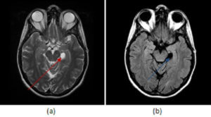 Choroidal Fissure Cyst - DocNeuro