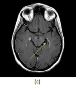 Choroidal Fissure Cyst - DocNeuro