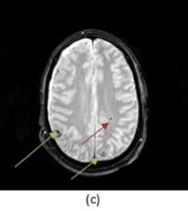 Diffuse Axonal Injury - DocNeuro