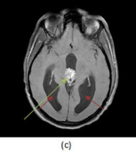 Germinoma - DocNeuro