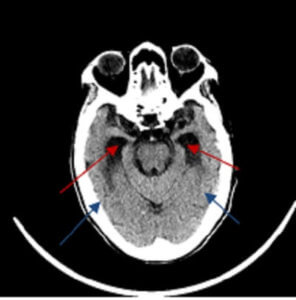 Nonobstructive Hydrocephalus – Normal Pressure Hydrocephalus - DocNeuro