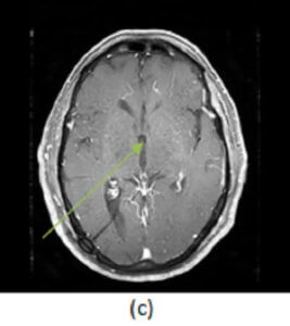 Obstructive Hydrocephalus – Colloid Cyst - DocNeuro