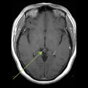 Pineal Cyst - DocNeuro