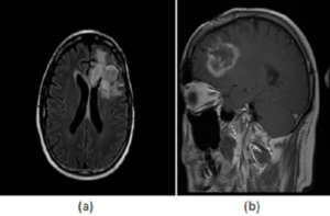 Radiation Necrosis - DocNeuro