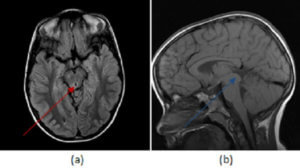 Tectal Plate Glioma - DocNeuro