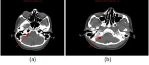 Vertebral Artery Dissection, CTA - DocNeuro