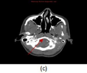 Vertebral Artery Dissection, CTA - DocNeuro