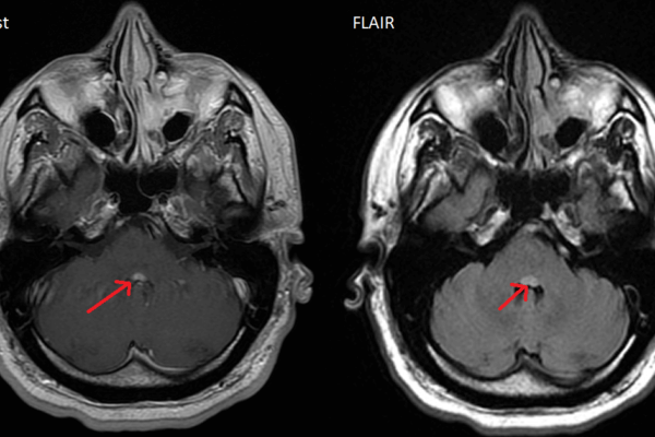 Oculocephalic Reflex - DocNeuro