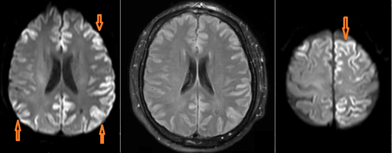 Creutzfeld-Jacob Disease - DocNeuro