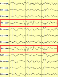 Non-REM sleep on EEG - DocNeuro