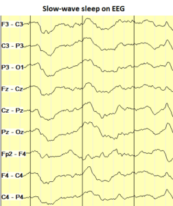 Non-REM sleep on EEG - DocNeuro