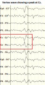 Non-REM sleep on EEG - DocNeuro