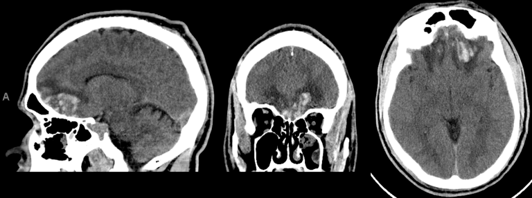 Frontal lobe syndromes - DocNeuro