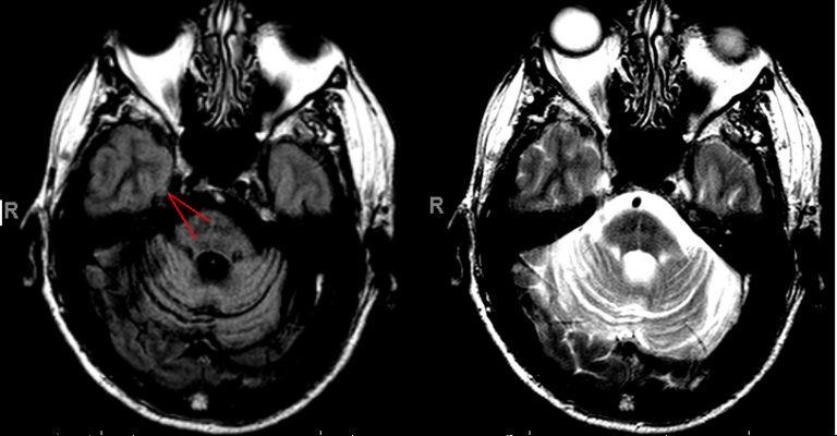 MSA hot cross buns sign - DocNeuro