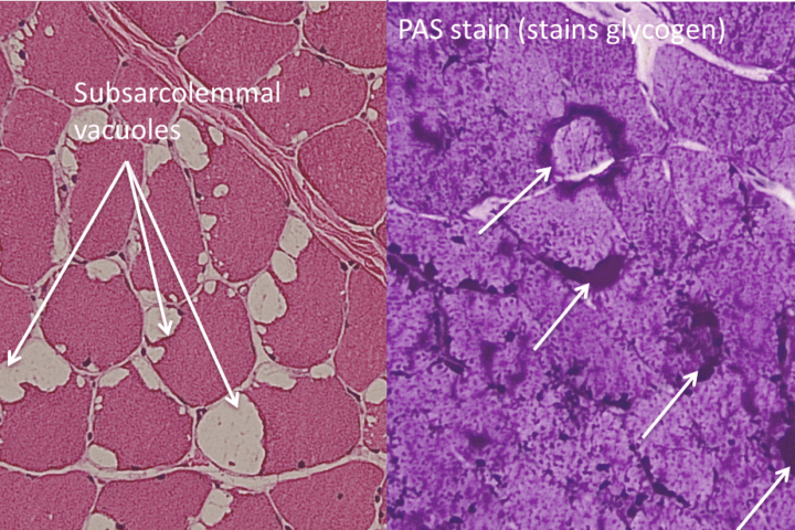 Carnitine palmitoyltransferase (CPT) deficiency - DocNeuro