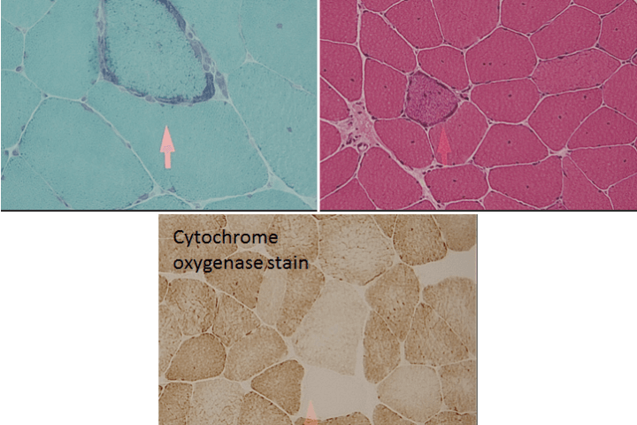 Carnitine palmitoyltransferase (CPT) deficiency - DocNeuro
